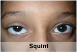 Mukherjee Eye Klinik :: Squint